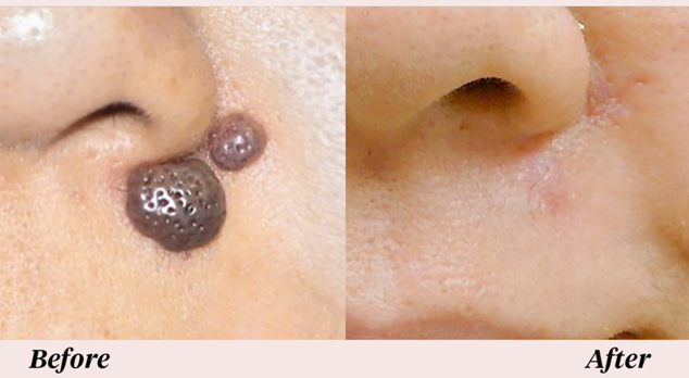 Surgical Mole Removal | Skin Clinic Pimpama & Paradise Point | Curvz
