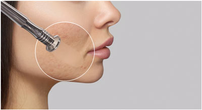 Microdermabrasion | Curvz | Pimpama & Paradise Point